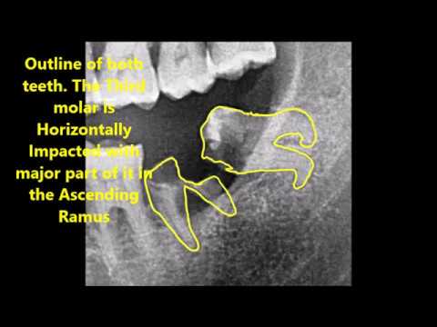 How to extract a Horizontally Impacted Third molar - YouTube
