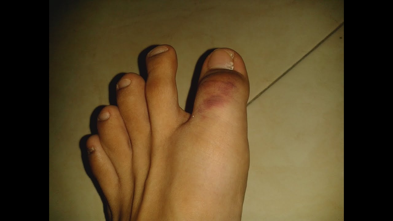 Información importante + dedo fracturado - YouTube