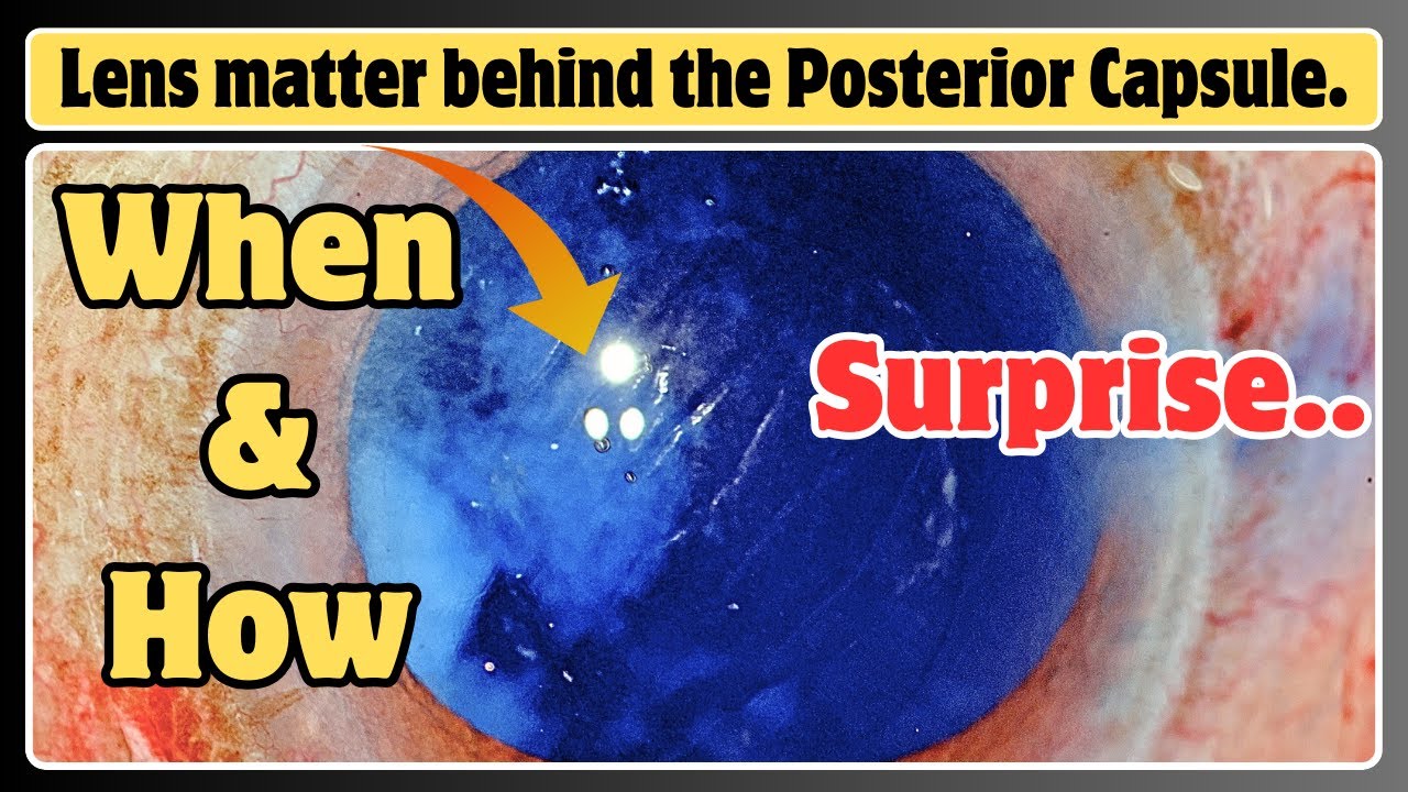 Surprise.. Lens matter behind the posterior capsule - Pars plana ...