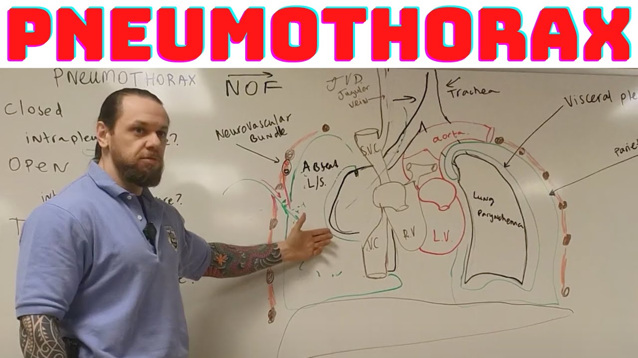 How to diagnose and treat Tension Pneumothorax with Needle ...