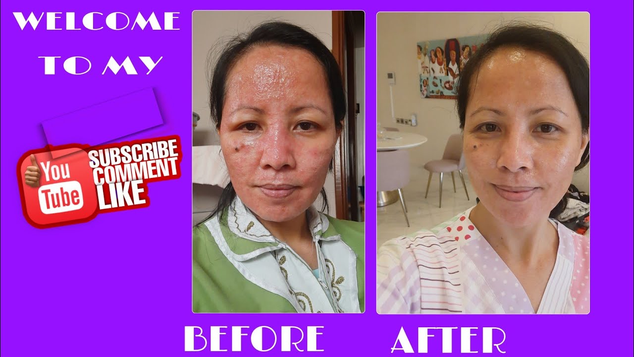 #ofwmideast #buhayastig # ANG PAG GALING NG ALLERGY SA MUKHA KO - YouTube