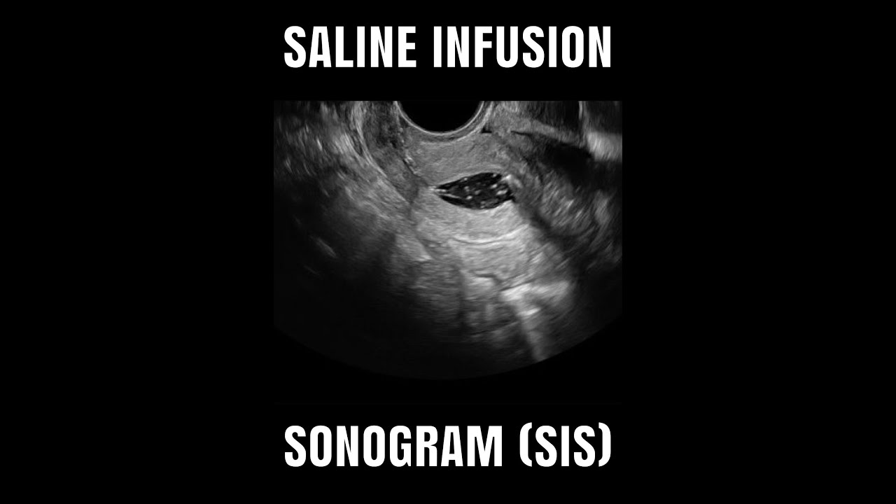 Saline Infusion Sonogram - YouTube