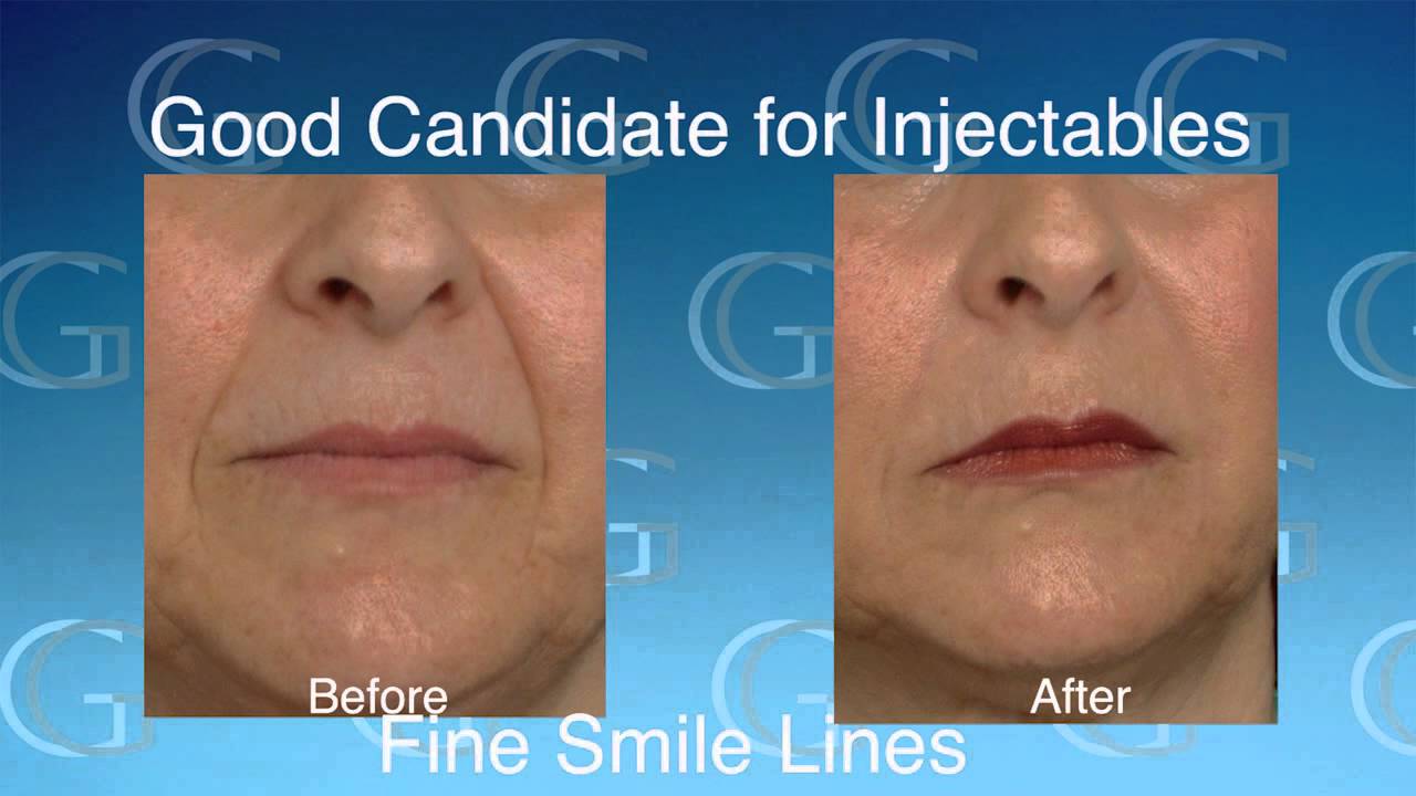 Injectables vs. Fat Transfer - New Jersey - Dr. Robert Glasgold - YouTube