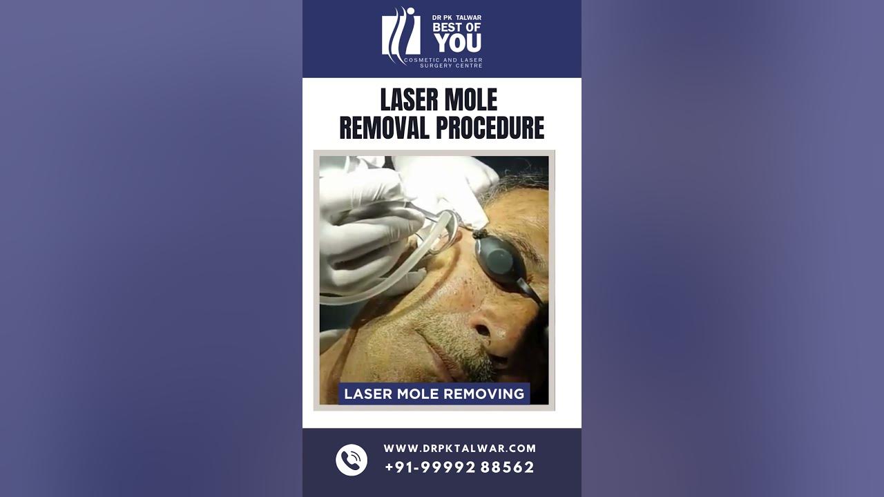 Laser Mole Removal Procedure | Before-After Mole Removal | Dr. PK ...
