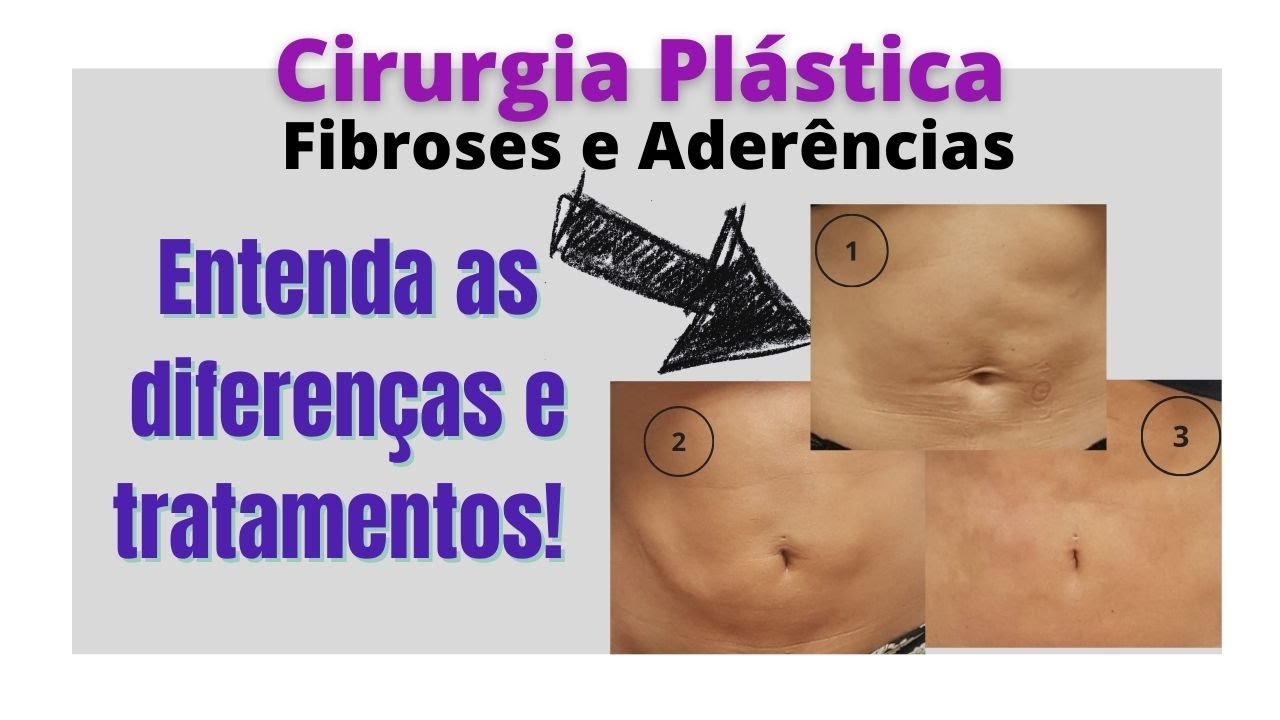 Fibroses e Aderências pós lipo, abdominoplastia: o que são e como ...