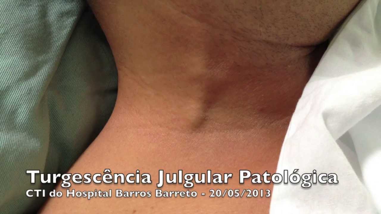Turgescência Julgular Patológica - YouTube