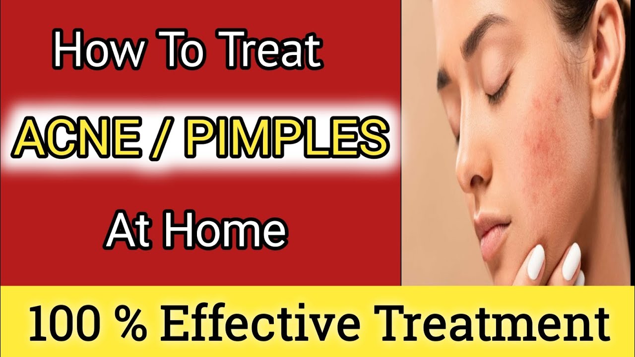 How to treat Acne and Pimples at home | how to remove acne and pimples ...