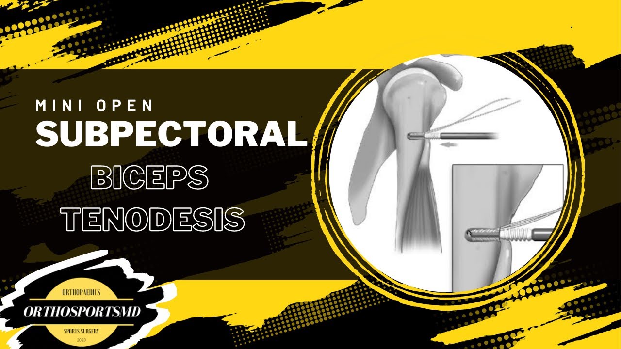 How to do a subpectoral biceps tenodesis - a step by step approach ...