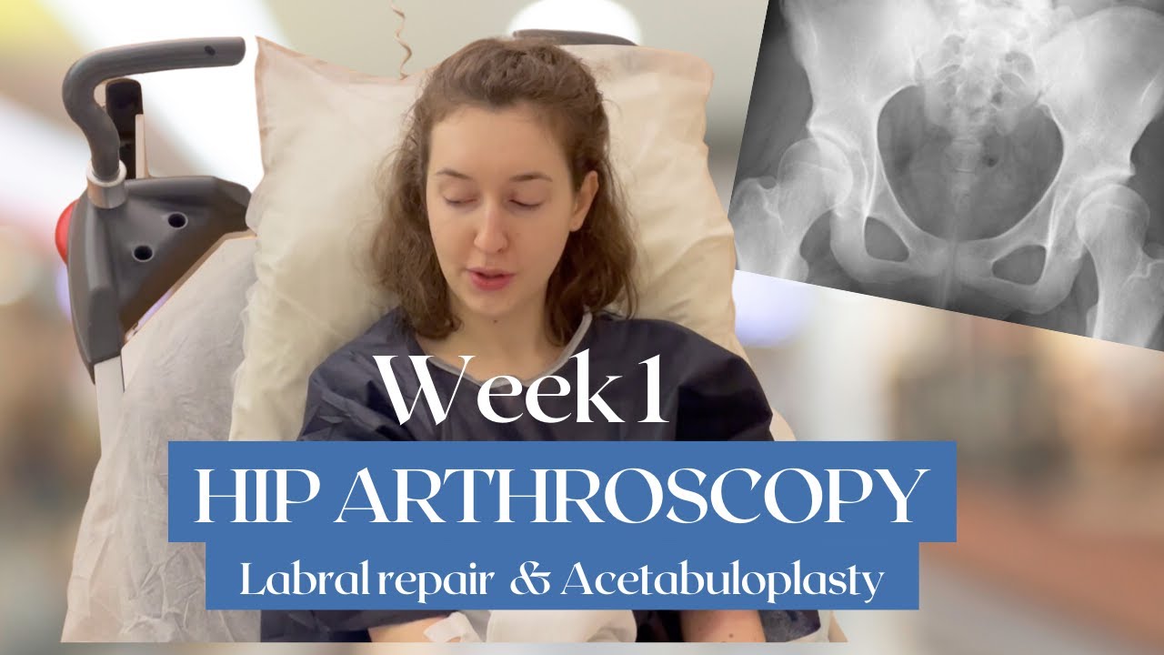 Week 1 Post-Surgery Experience: Labral repair & Acetabuloplasty | Hip ...