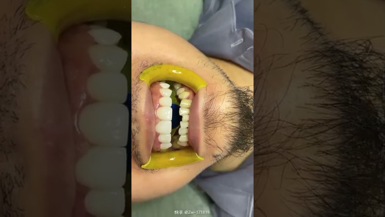 Tooth Filling ::: Cuspid Tooth Extraction ::: Teeth Expander Process ...