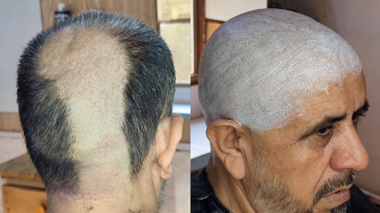 How to smooth head shave straight razor tutorial, dandruff and pimple ...