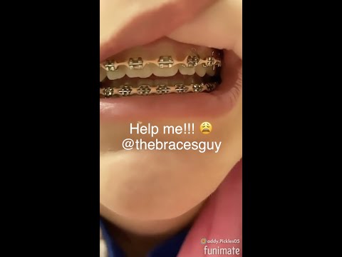 What Are The Hooks On My Braces For