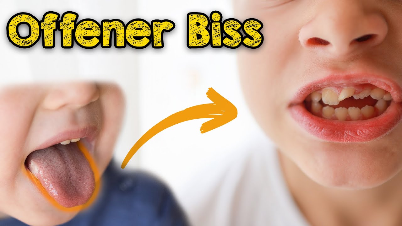 Offener Biss: Von Ursachen bis Lösungen - YouTube