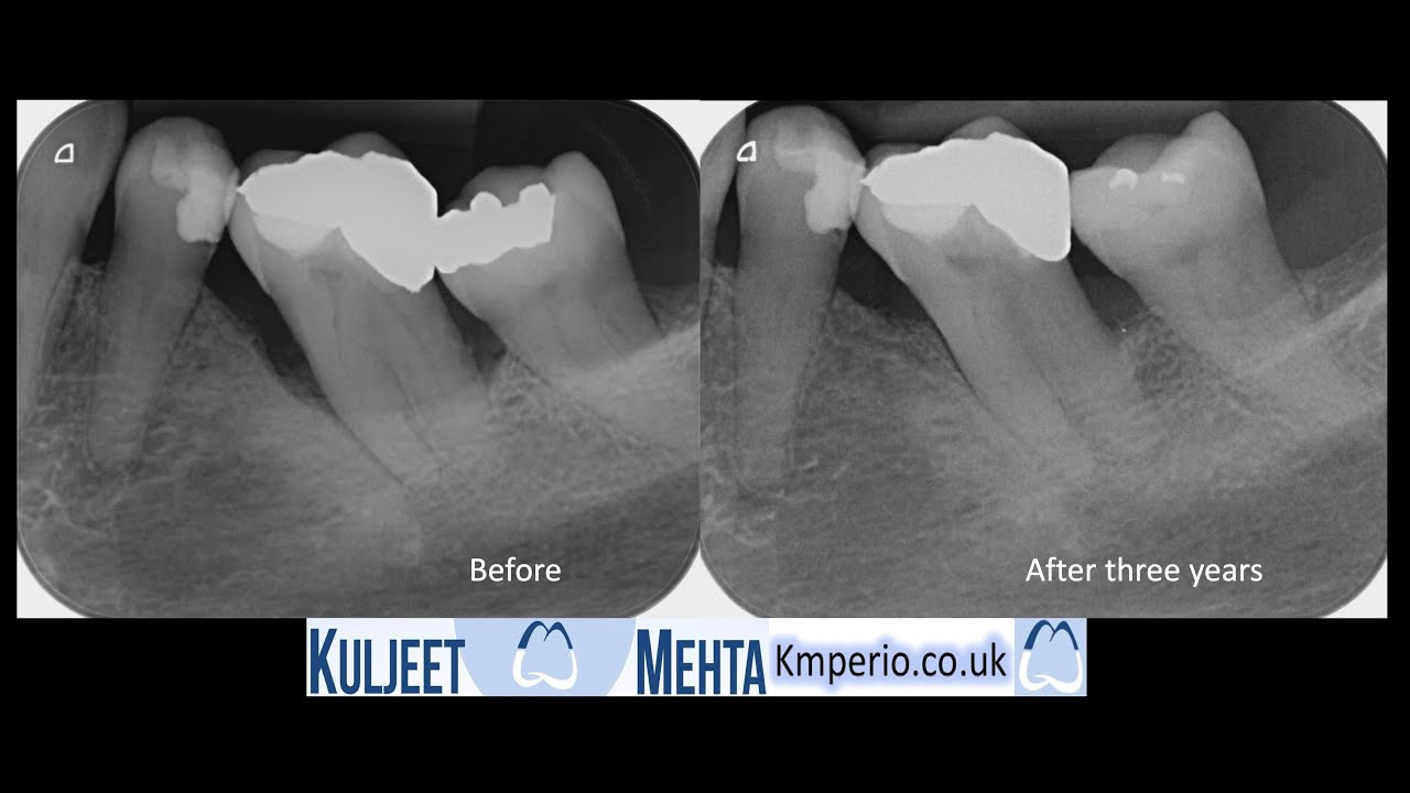 Periodontal Surgery with GTR lower left molars - YouTube
