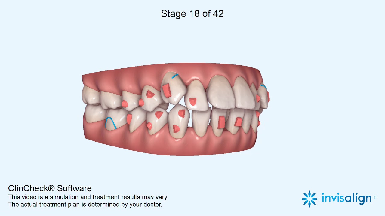 Invisalign Simulation - YouTube