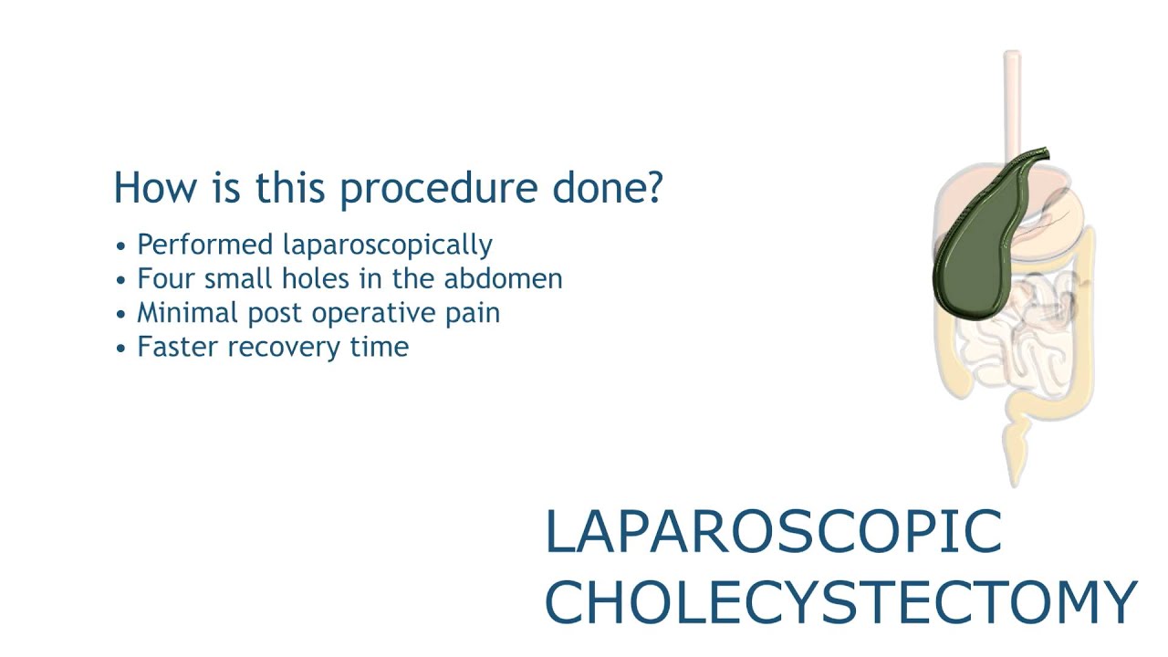 MUSC GI Surgery: laparoscopic cholecystectomy - YouTube