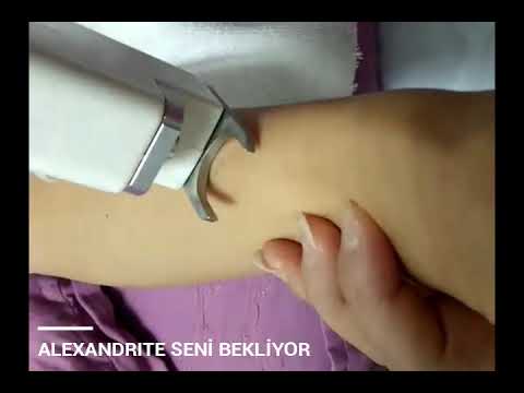 Alexandrite Candela​ özdemir lazer medikal
