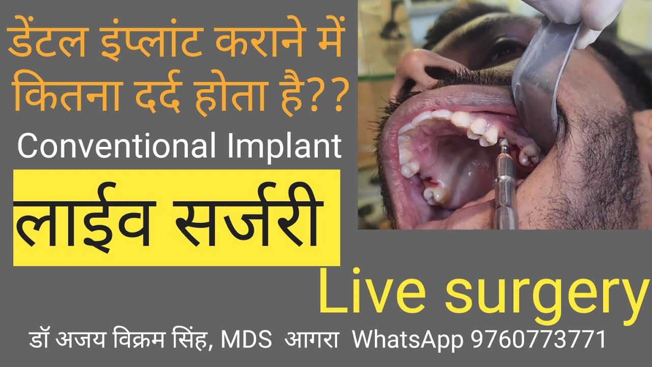 Conventional Implant live surgery - YouTube