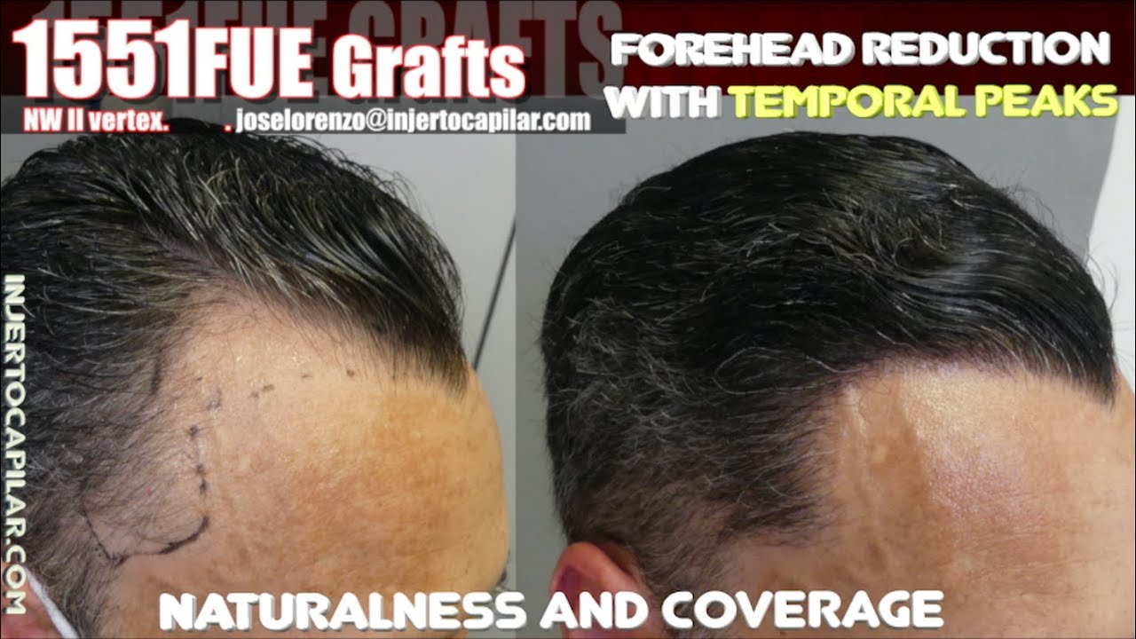 1551Grafts.NW II V.Forehead reduction with temporal peaks.10mths update ...