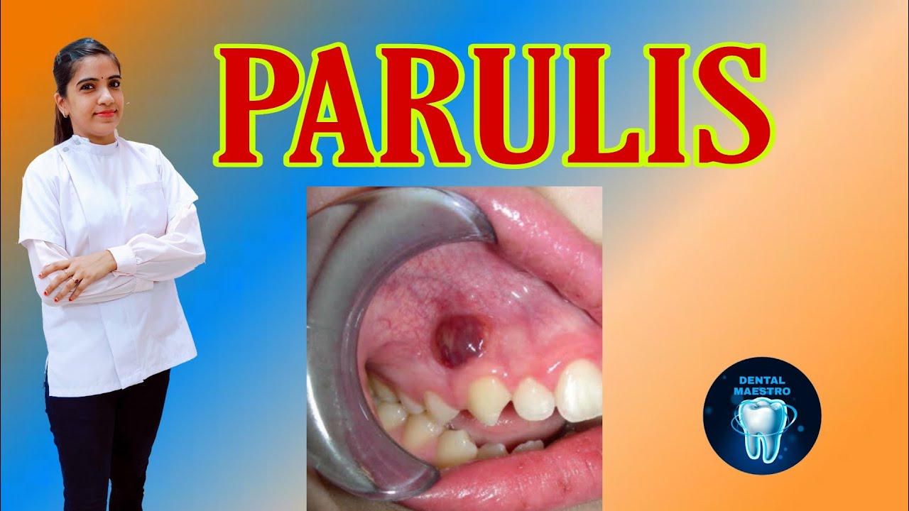 Parulis | gum swelling | how to treat gum swelling | gum infection ...