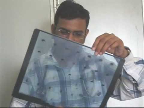 what is dtpa scan for kidneys? - YouTube