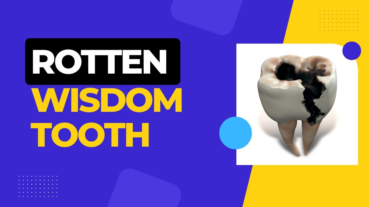 Rotten Wisdom Tooth: 2 Professional Treatment Options - YouTube