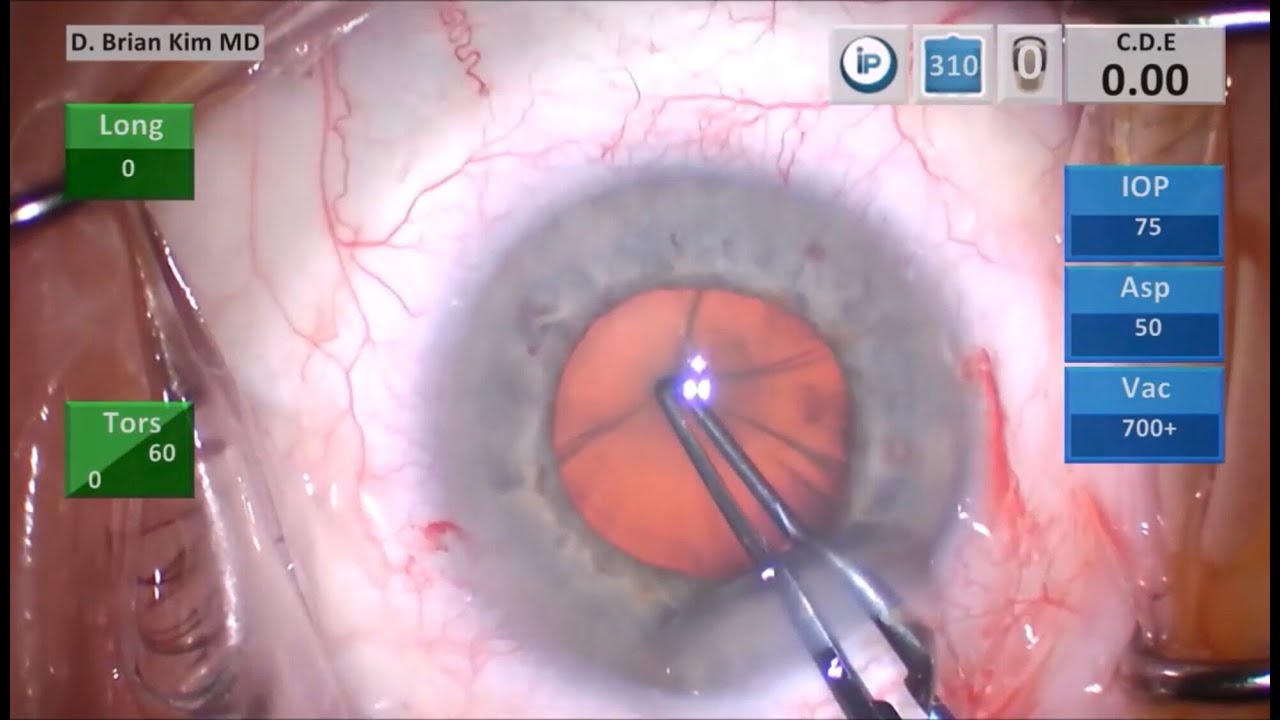 My Pearls to Identify & Treat Weak Zonules - YouTube
