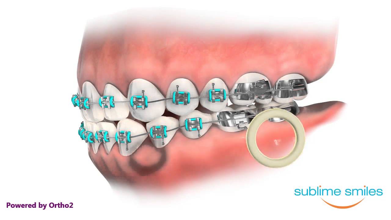 Class III Elastics - YouTube
