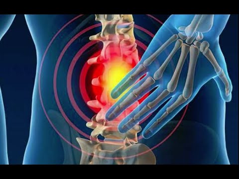 Spondiliti ankilozant eshte semundje ........ - YouTube