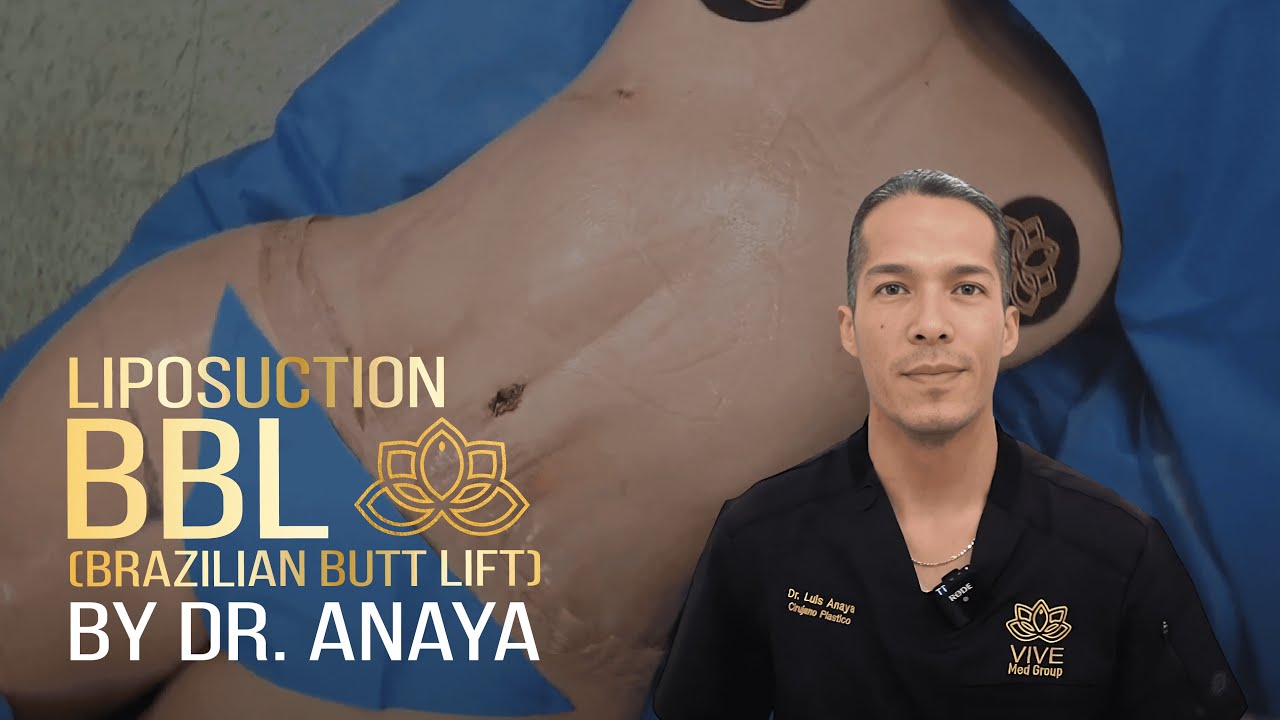 LIPOSUCTION BBL (BRAZILIAN BUTT LIFT)- by Dr. Anaya - YouTube