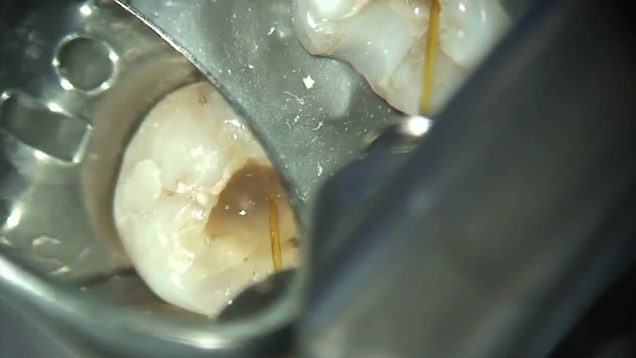 Photon Induced Photoacoustic Streaming (PIPS™*) Laser Endo - YouTube