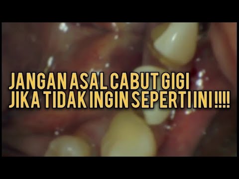 Akibat cabut gigi yang bikin pasien menyesal - YouTube