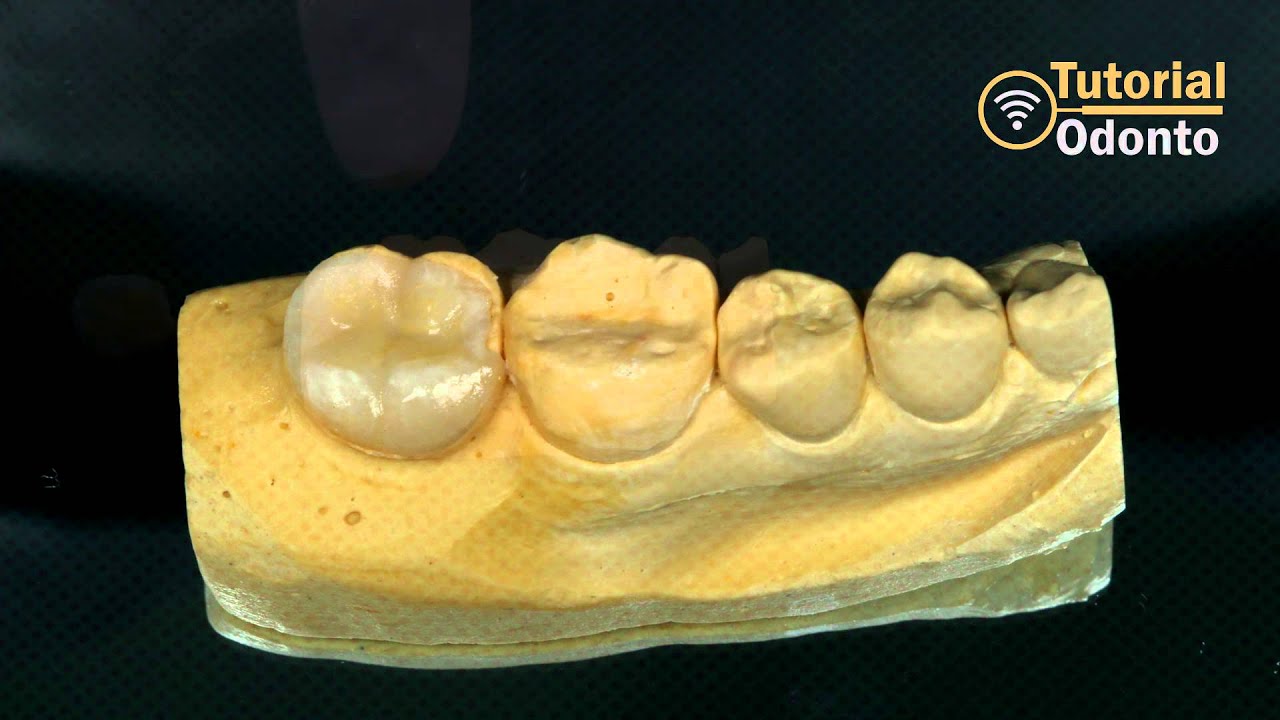 Endo crown: uma alternativa para espaço interoclusal limitado (HD ...