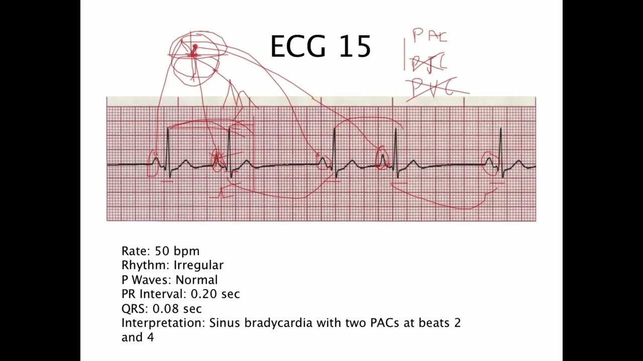 23 EKG premature atrial contraction | ការរៀនអាន ECG លើអ្នកជំងឺមាន PAC ...