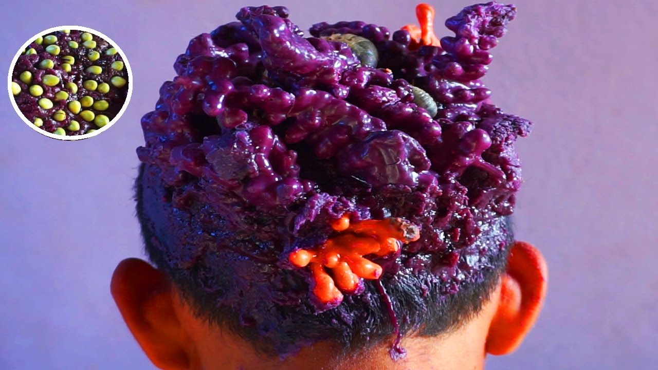 Unbelievable Worms!! Satisfying Dandruff Removal And Picking Strange ...