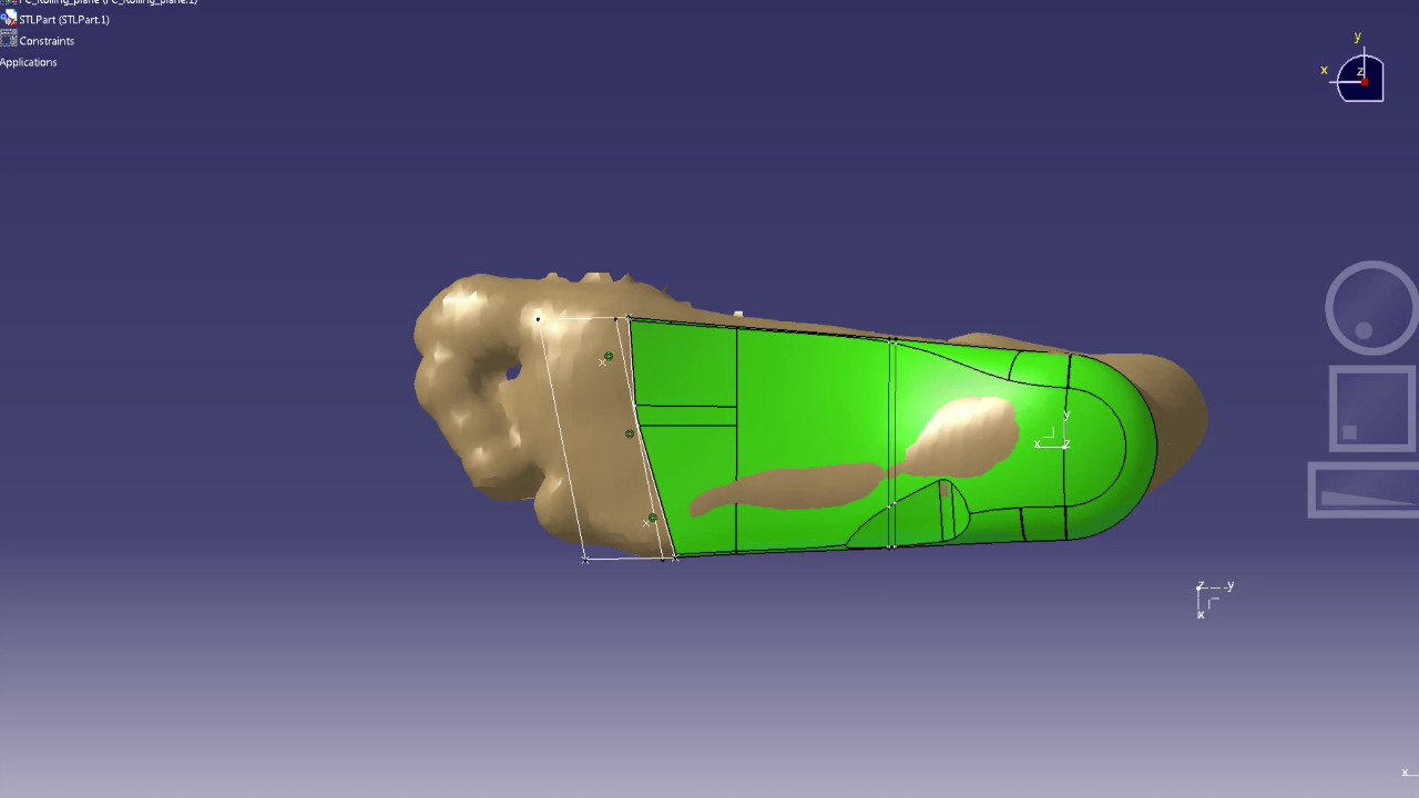 Lateral Wedging for Medial Knee Osteoarthritis - YouTube