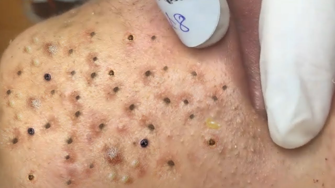 Big Cystic Acne Blackheads Extraction Blackheads & Milia, Whiteheads ...