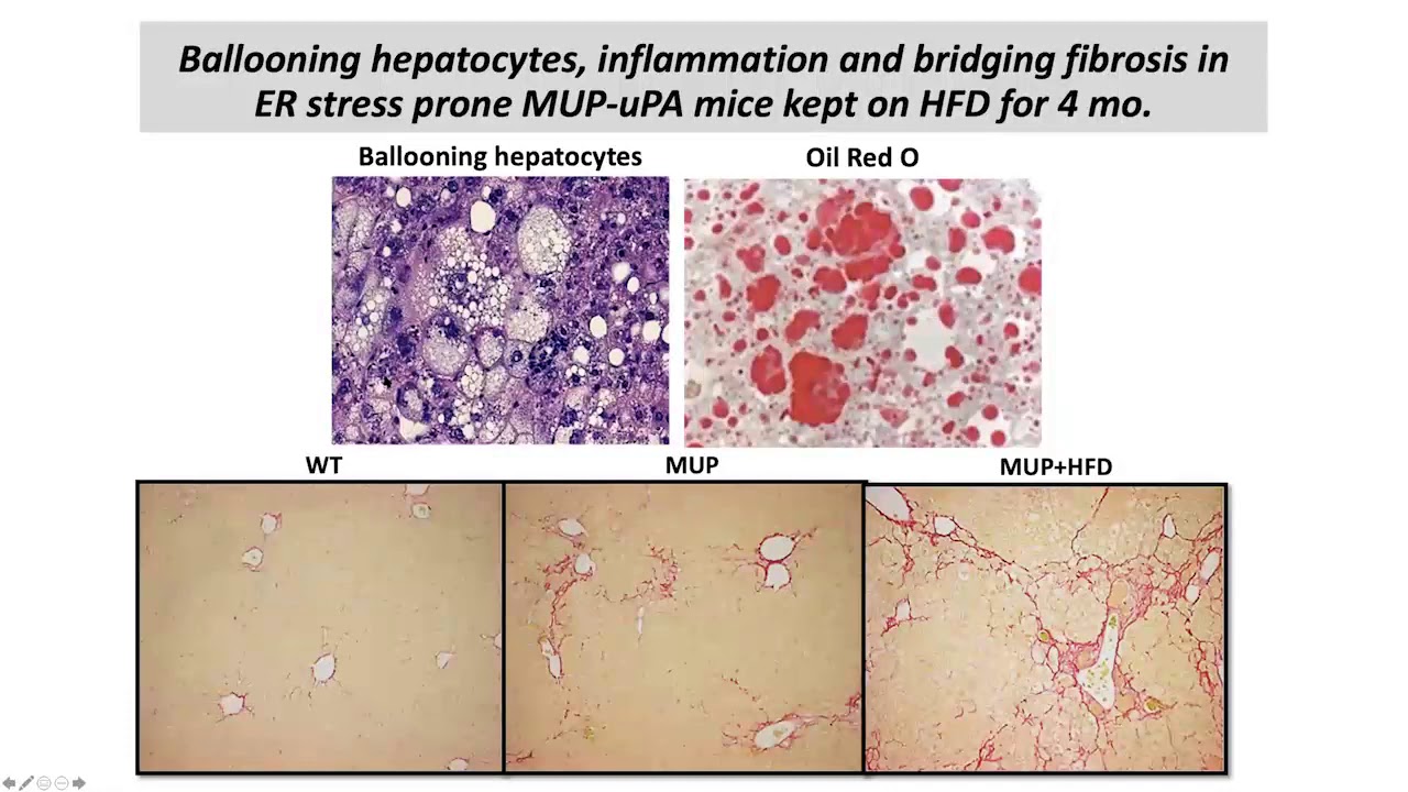 Inflammation, Metabolism and Immunity in Liver Cancer: From ...