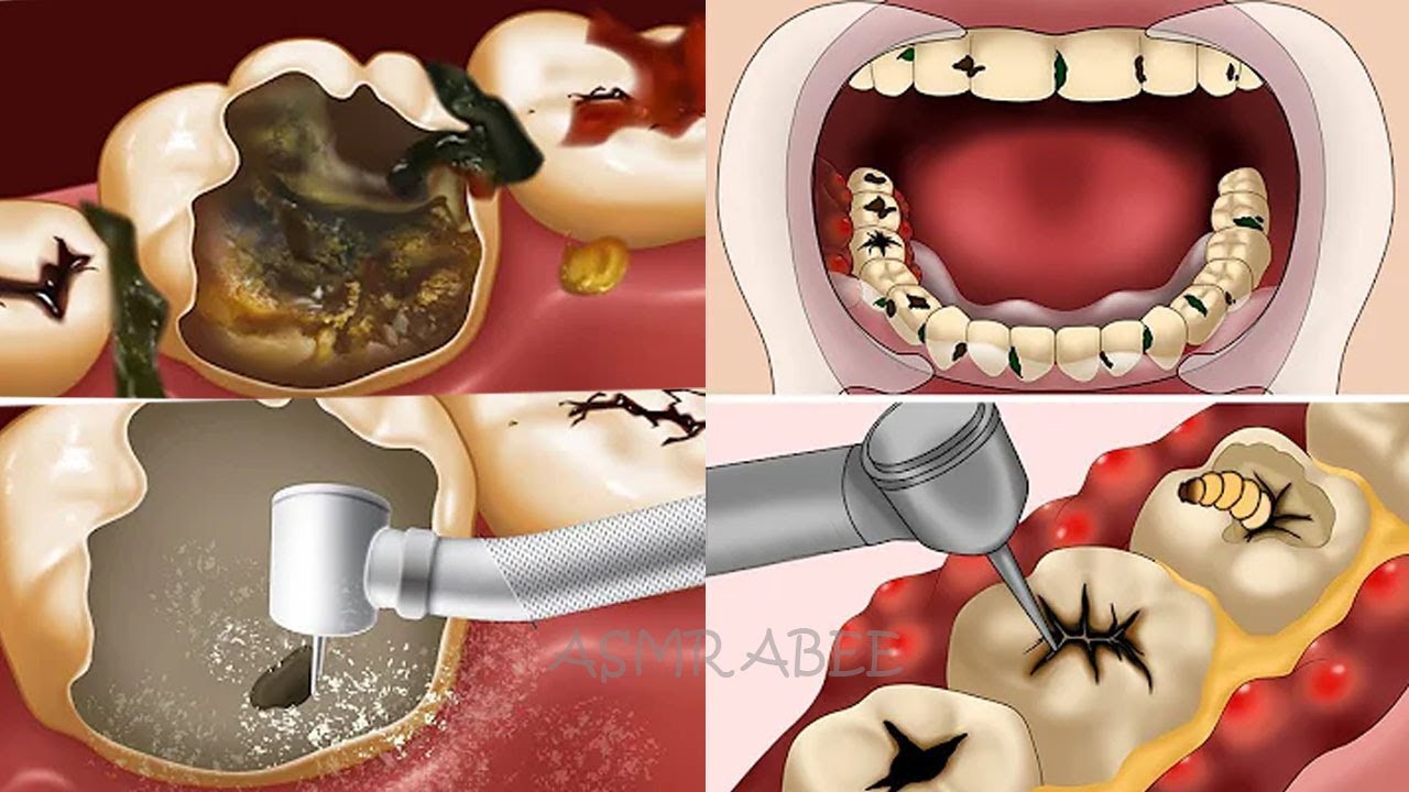 Cleaning cavities due to worms, Treatment of yellow tooth crust | Asmr ...