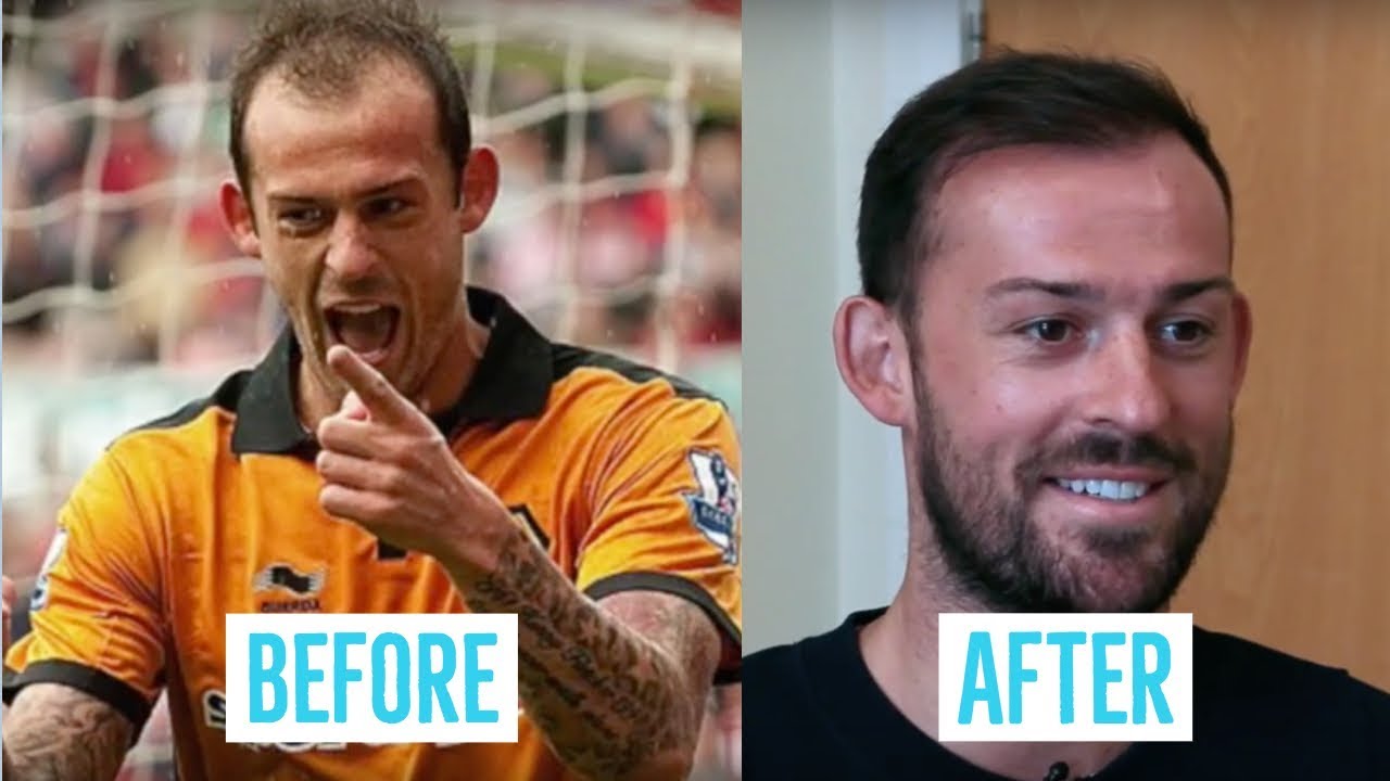 Hair Transplant Results - Steven Fletcher's before and after - YouTube