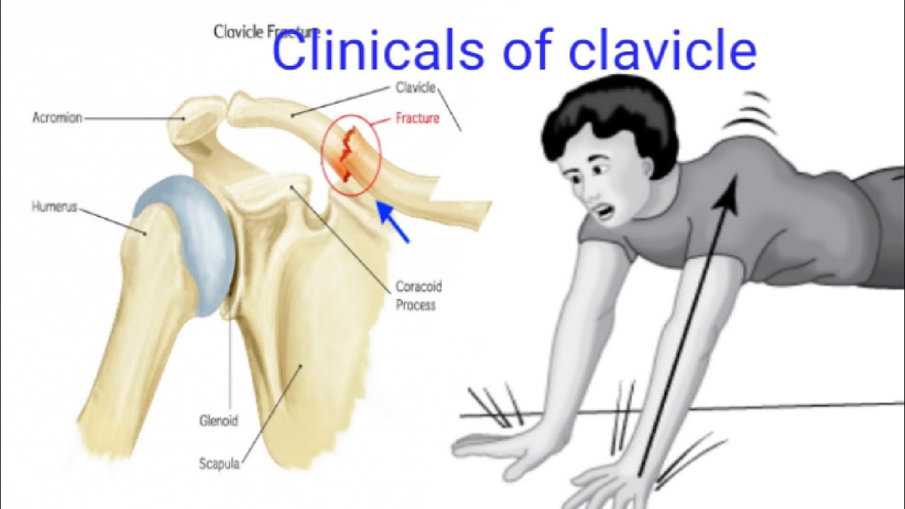 Clinicals Of Clavicle Bone In Hindi urdu Clinicals Of Collar Bone Clinicals Of Clavicle Bone In Hindi urdu Clinicals Of Collar Bone