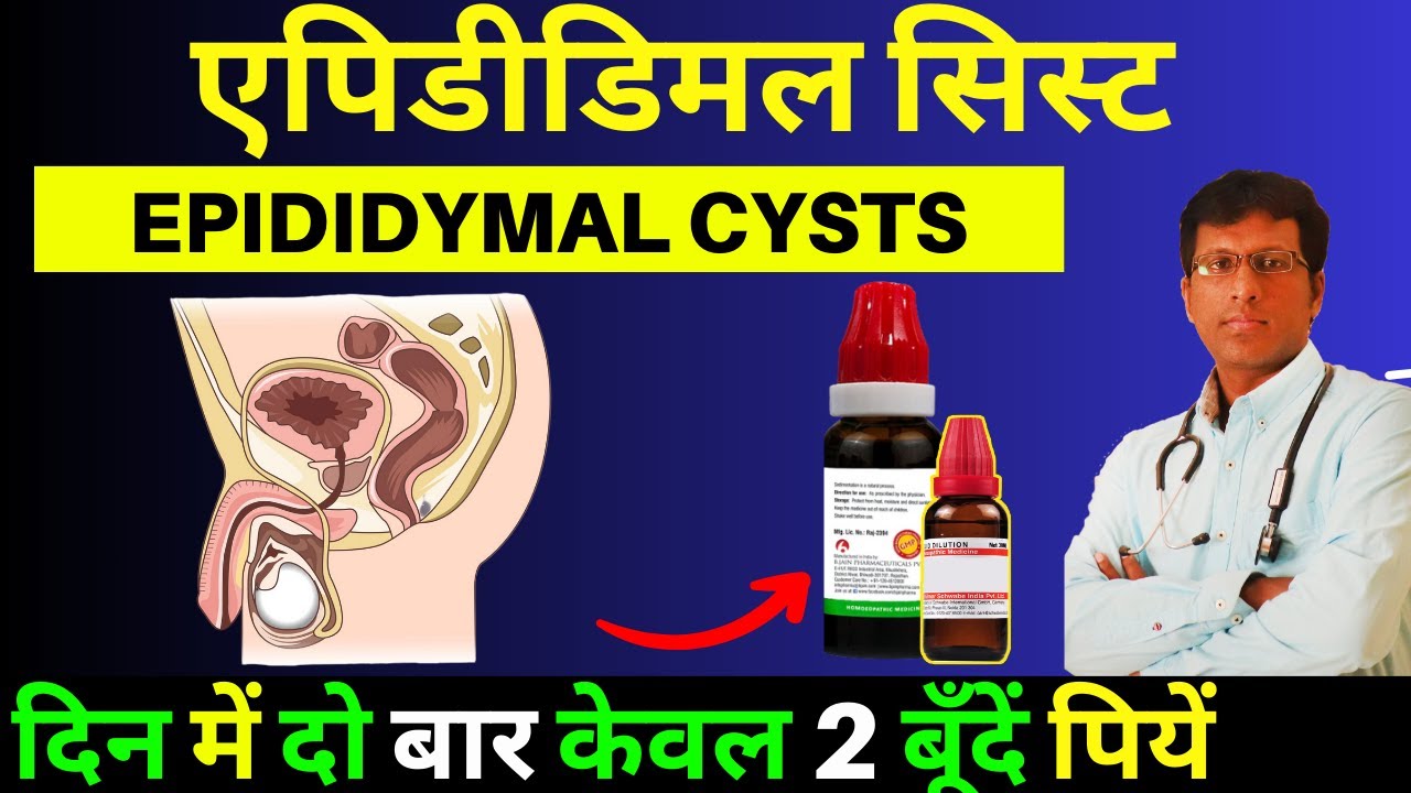 Homeopathy Medicine for Epididymal Cysts एपिडीडिमल सिस्ट - YouTube
