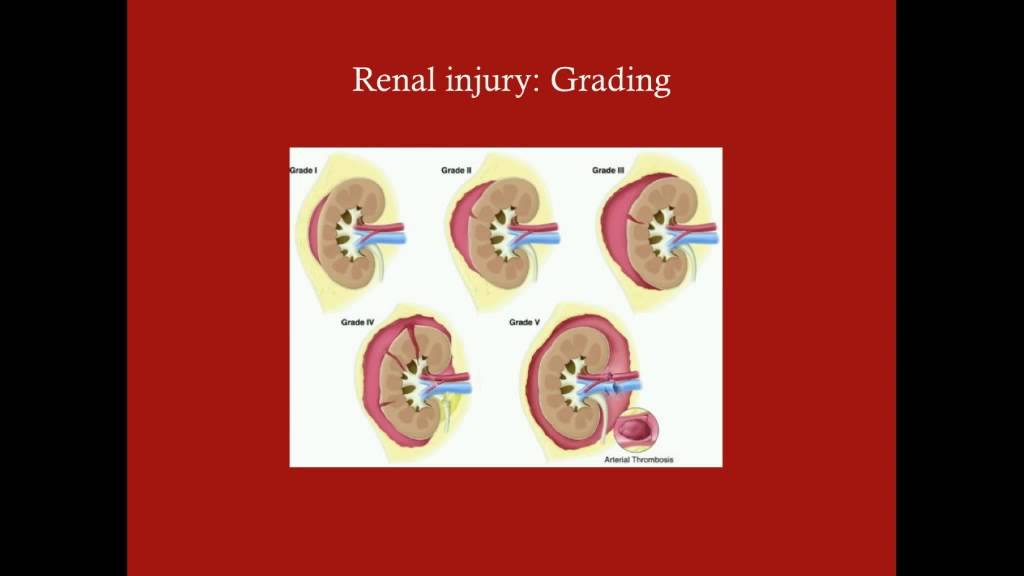 Proximal Genitourinary Trauma - CRASH! Medical Review Series - YouTube