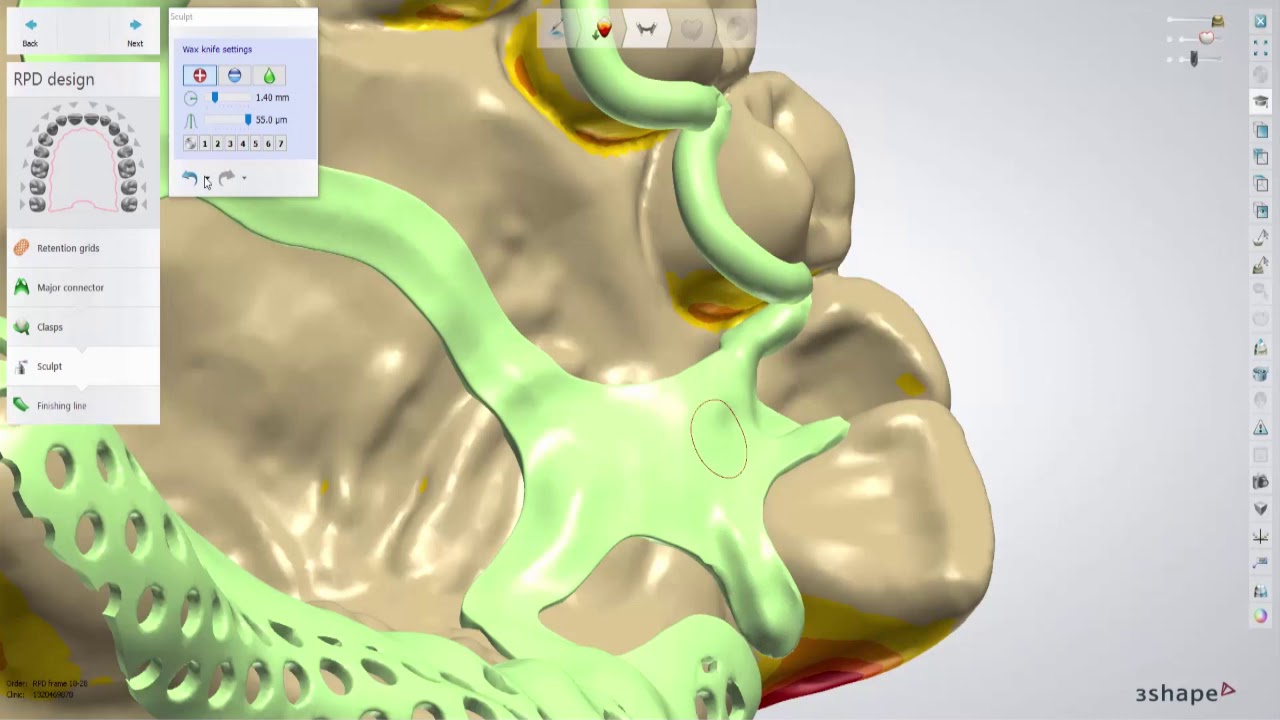 240 - Upper RPD Class II - YouTube
