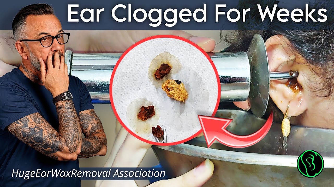 Ear wax removal water flush #earwaxremoval #earcleaning - YouTube