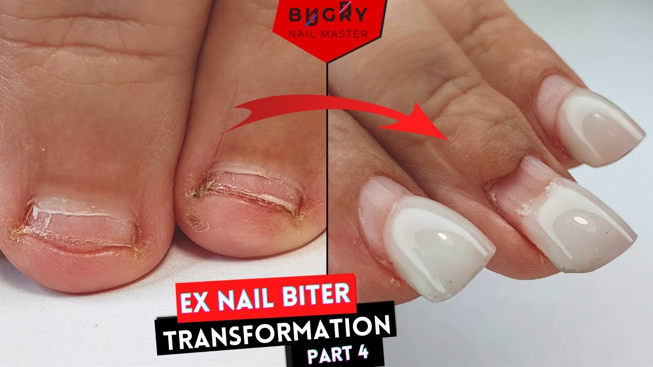 Ex Nail Biter Transformation Finale | Couldn't Believe My Eyes! | 2 ...