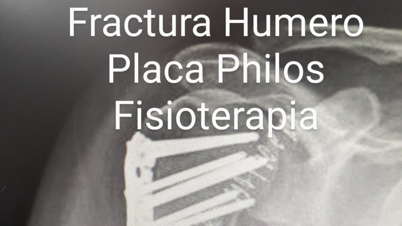 Fractura humero con Placa Philos: fisioterapia - YouTube
