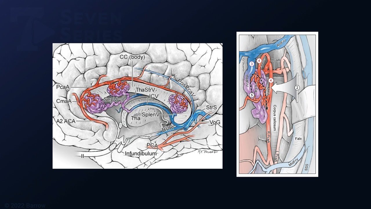 Anterior Interhemispheric Approach for Resection of a Collosal and ...