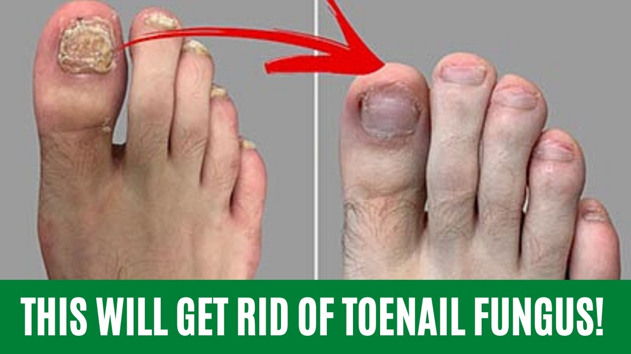 Get Rid of Toenail Fungus Quick and Naturally | Treat Toenail Fungus ...