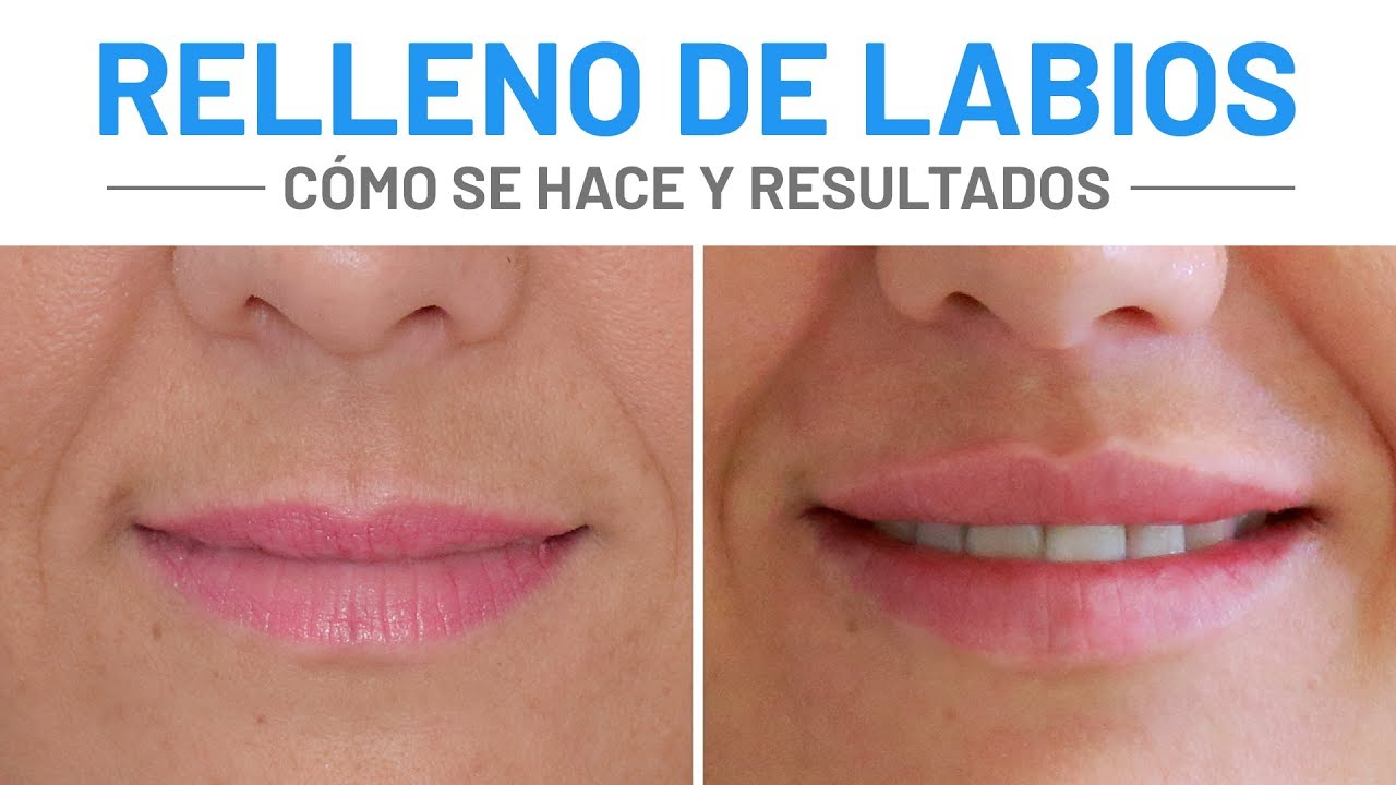 Aumento de Labios | Resultados sorprendentes en Clínicas Diego de León ...